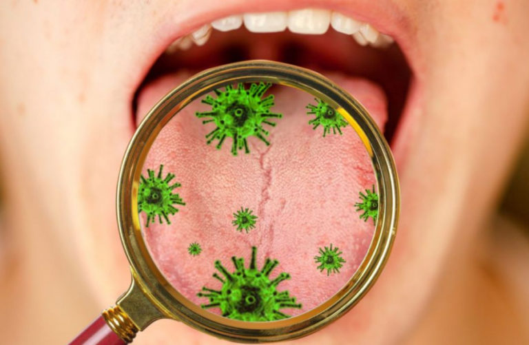 Afte dureroase, abcese și ulcerații pe limbă, noi simptome de Covid-19